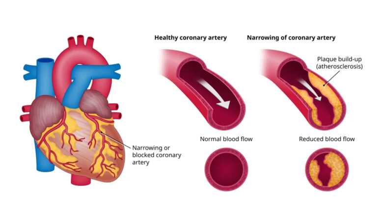 Coronary Artery Disease (CAD) | Symptoms, Causes & Treatment
